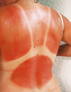 Sunburns – More About – Corium 21