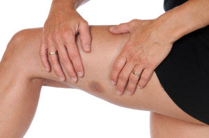 Bruising – Corium 21