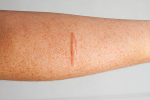 Scarring, Scars – Corium 21